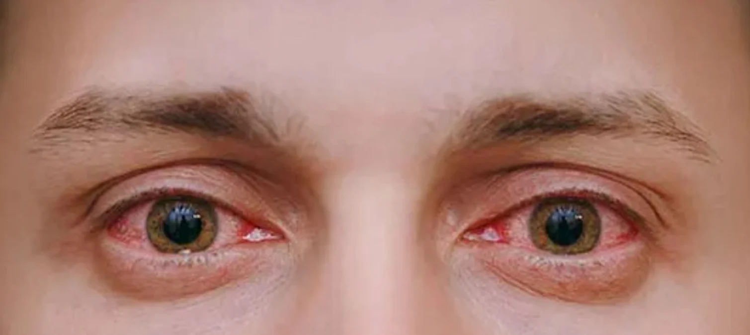 Mata Tegang atau Pusing Tanda Minus Naik? Ini Jawabannya… – Radar ...