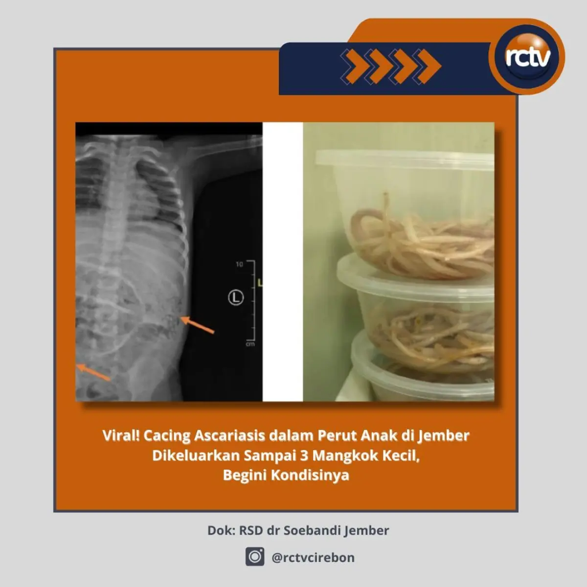 Perut Anak Berusia 3 Tahun di Jember Dipenuhi Cacing – Radar Cirebon Televisi